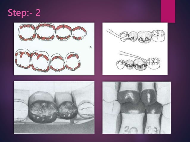 Wax patterns fabrication for fixed partial dentures | PPTX | Oral care ...