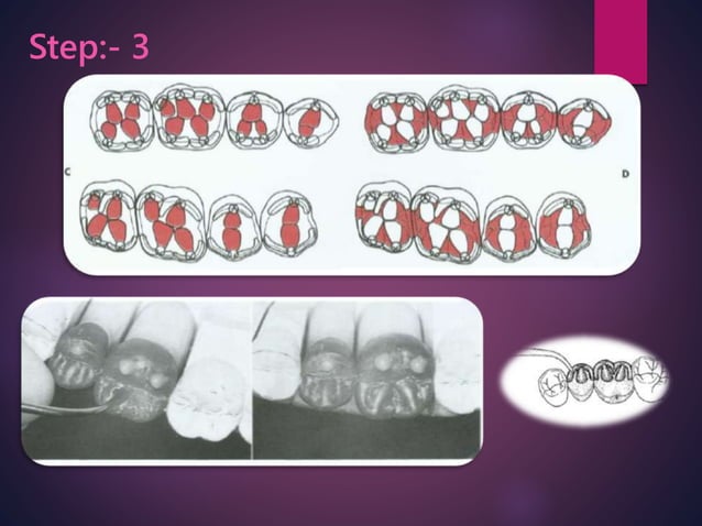 Wax patterns fabrication for fixed partial dentures | PPTX | Oral care ...