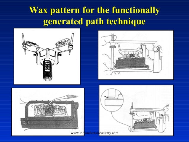 Wax patterns in fpd/ dentistry course in india