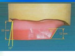 Wax rims & jaw relations | PDF