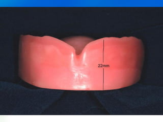 Wax rims & jaw relations | PDF