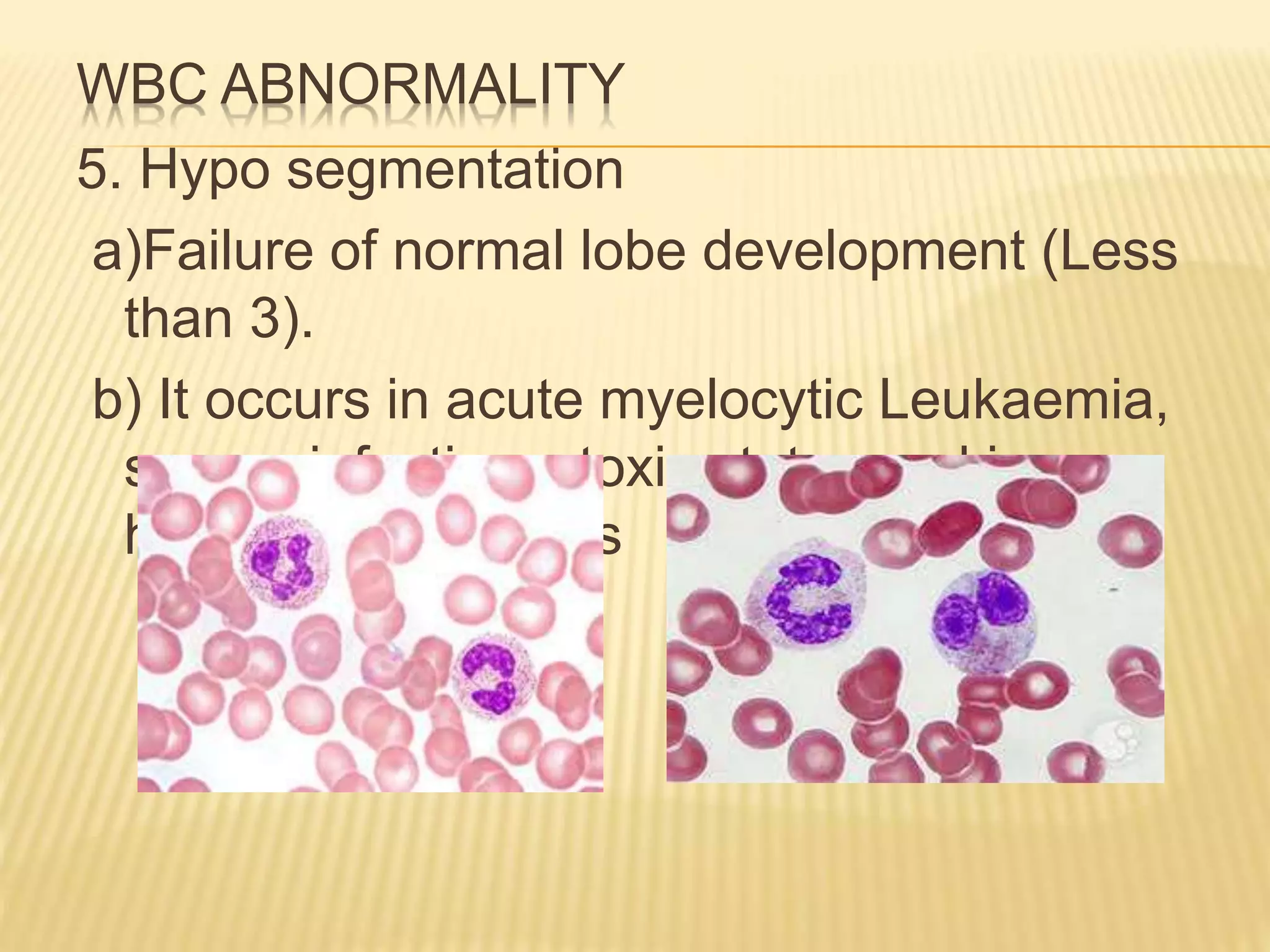 Wbc abnormality | PPTX