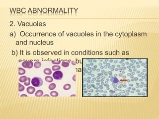 Wbc abnormality | PPTX