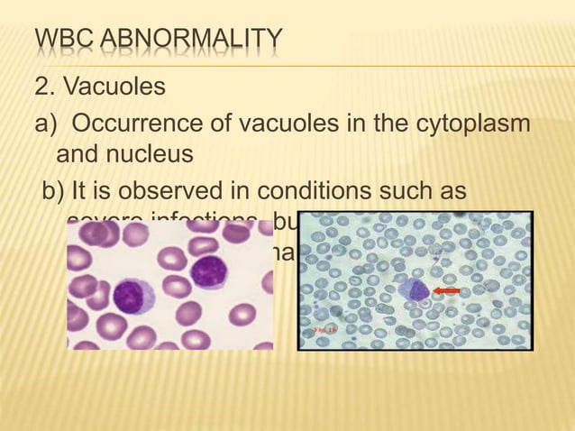 Wbc abnormality | PPT