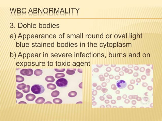 Wbc abnormality | PPT