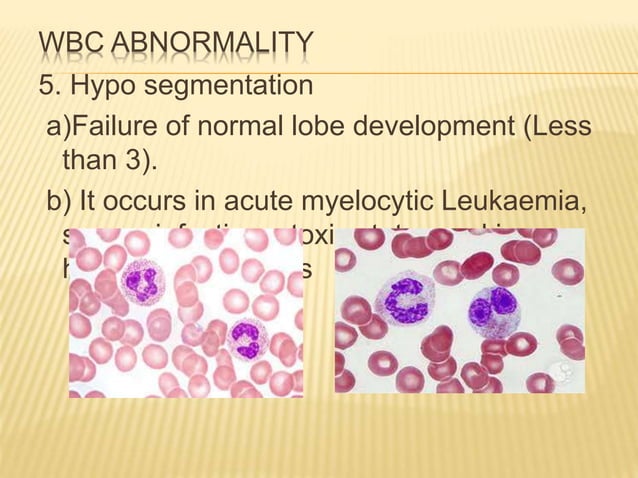 Wbc abnormality | PPT