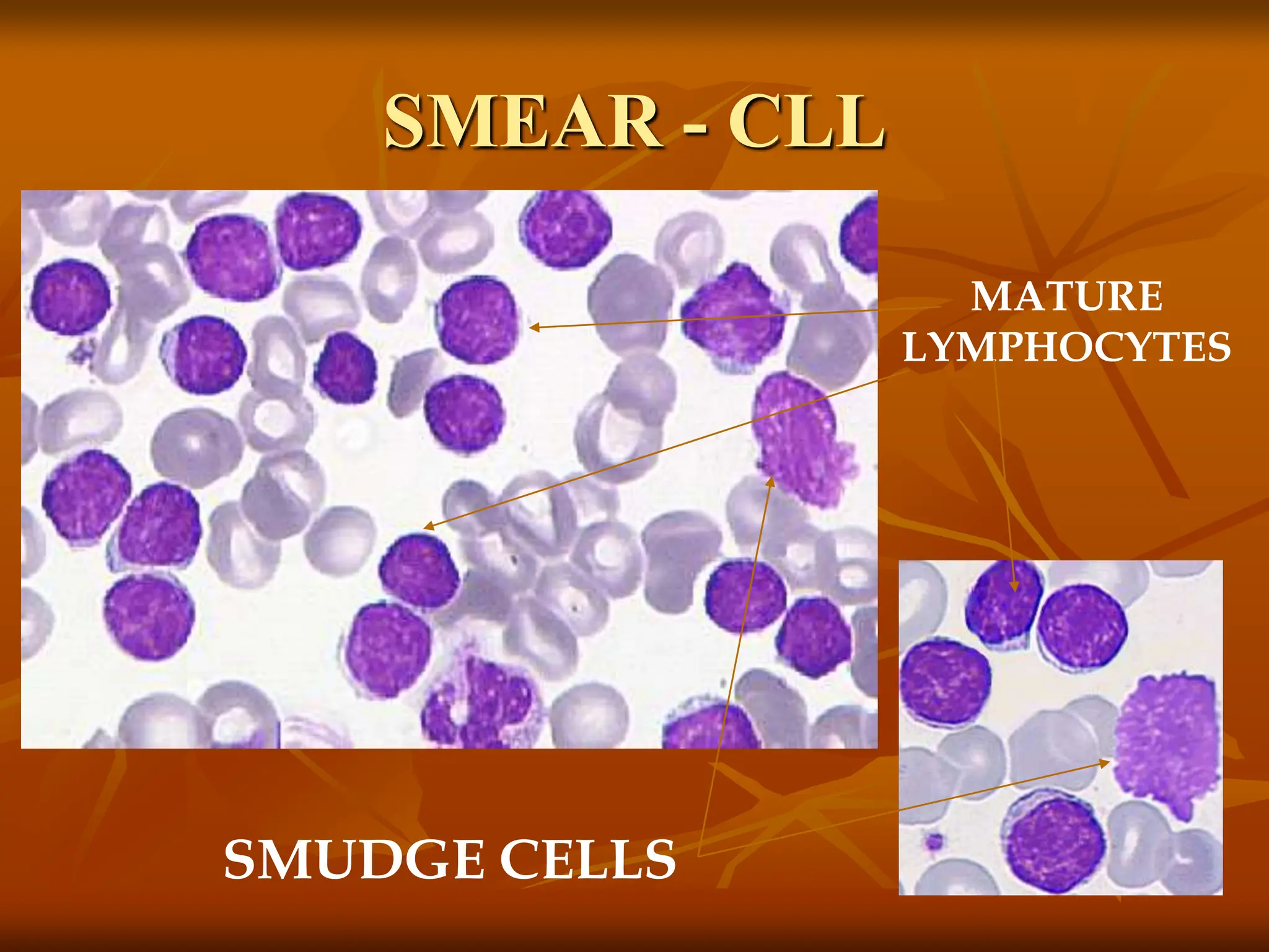 WBC DISORDERS.ppt………………………………………………………….. | PPT
