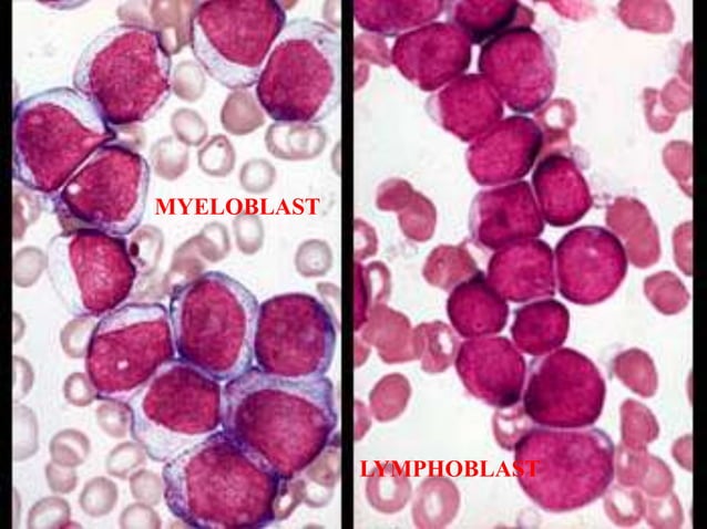 WBC DISORDERS.ppt………………………………………………………….. | PPT