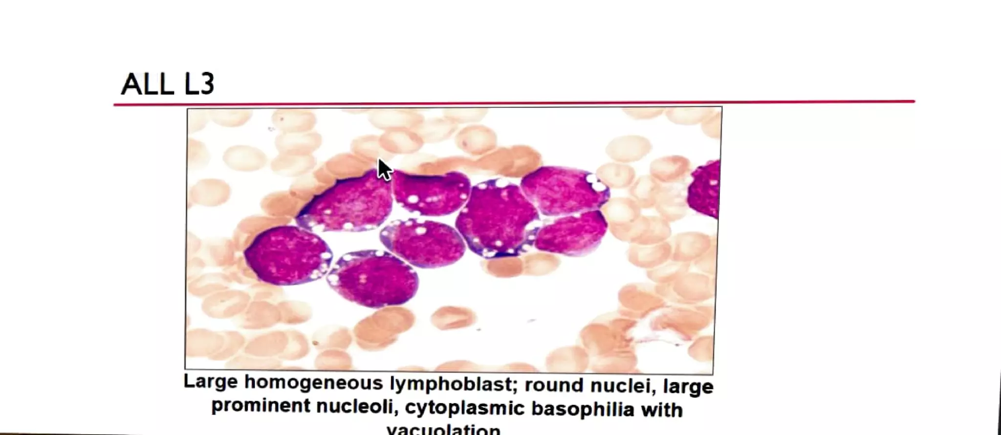 Wbc disorders 2 pathology | PDF