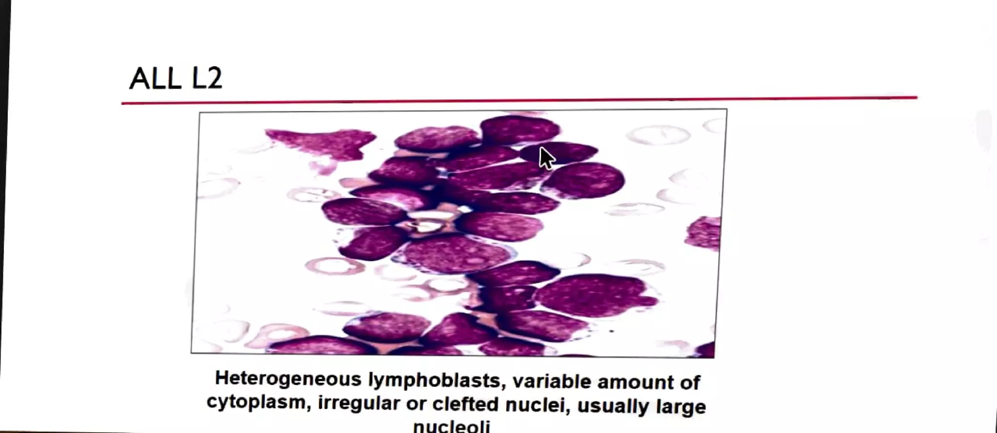 Wbc disorders 2 pathology | PDF