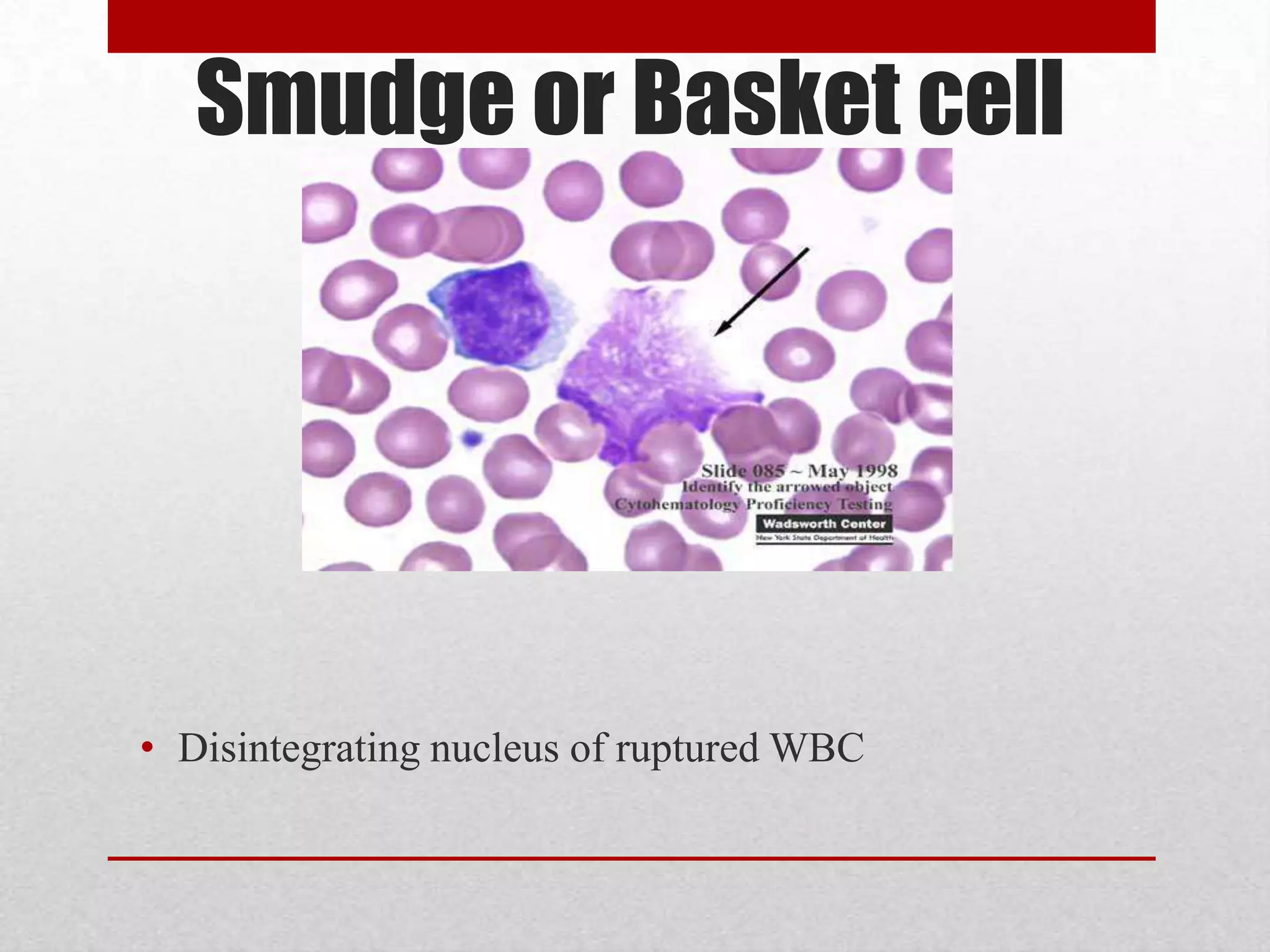 Wbc & platelets anomalies | PPTX