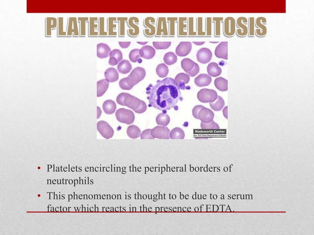 Wbc & platelets anomalies | PPTX | Blood Disorders | Diseases and ...