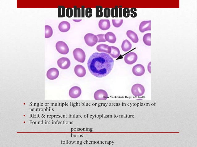 Wbc & platelets anomalies | PPTX | Blood Disorders | Diseases and ...