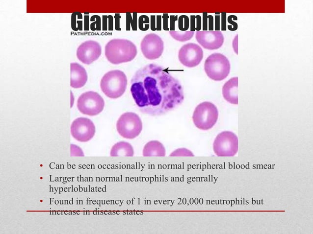 Wbc & platelets anomalies | PPTX | Blood Disorders | Diseases and ...