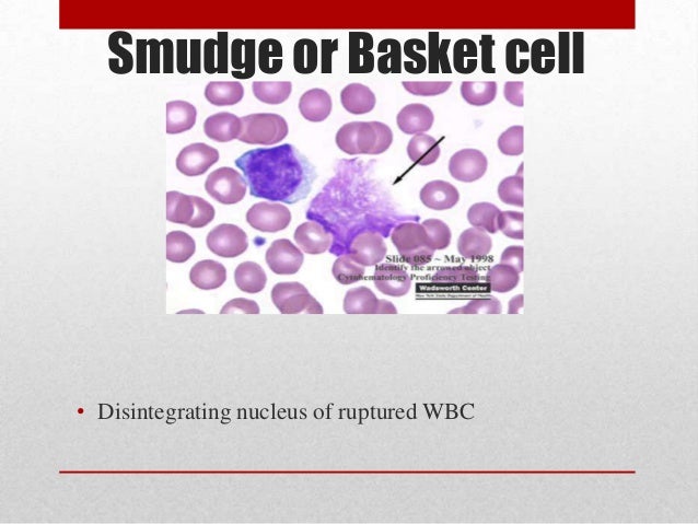 Wbc & platelets anomalies