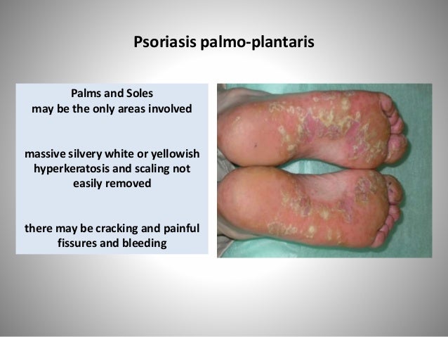 Psoriasis