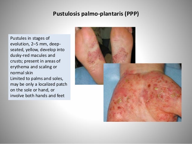 Psoriasis