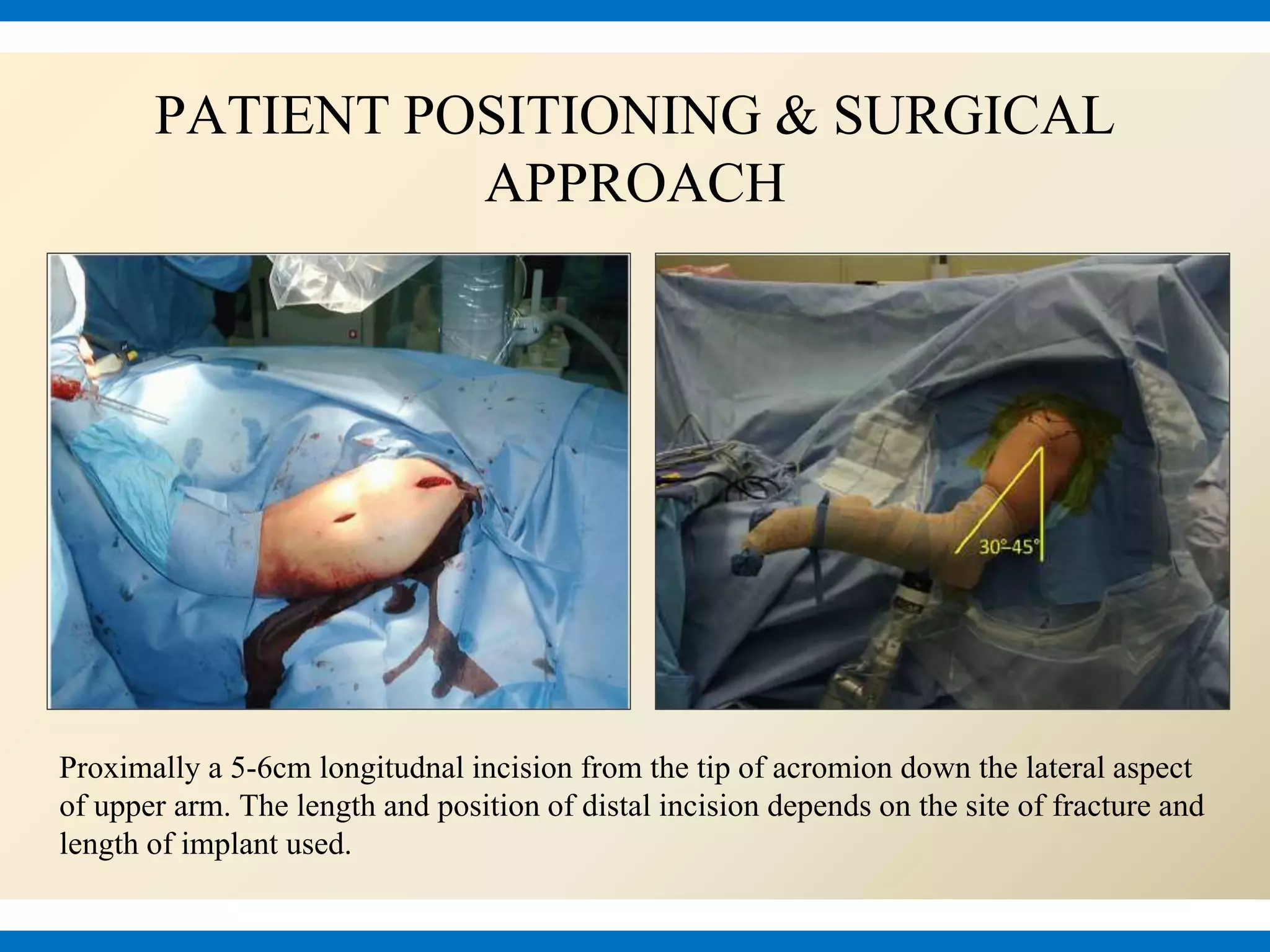 MIPO TECHNIQUE FOR PROXIMAL HUMERUS FRACTURE | PPTX
