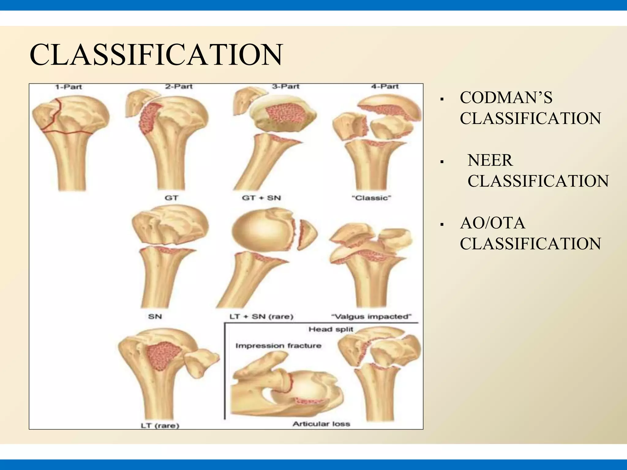 MIPO TECHNIQUE FOR PROXIMAL HUMERUS FRACTURE | PPTX