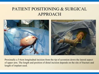 MIPO TECHNIQUE FOR PROXIMAL HUMERUS FRACTURE | PPTX
