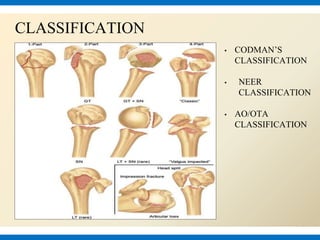 MIPO TECHNIQUE FOR PROXIMAL HUMERUS FRACTURE | PPTX | Death, Injury, or ...