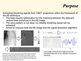Robust breathing signal extraction from cone beam CT projections based on adaptive and global ...