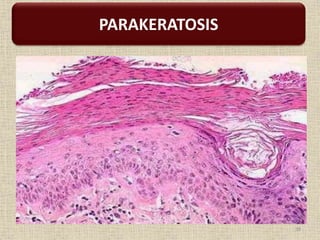 Parakeratosis Histology
