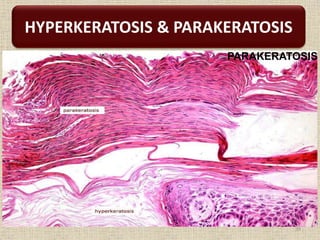 Parakeratosis Histology