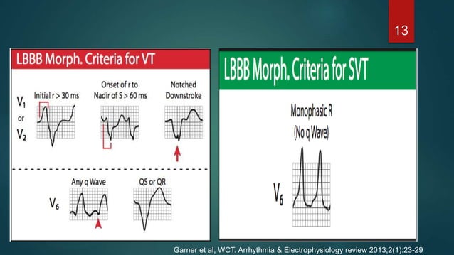 approach to wide complex tachycardia | PPTX | Heart and Cardiovascular ...