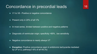 approach to wide complex tachycardia | PPTX
