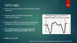 approach to wide complex tachycardia | PPTX