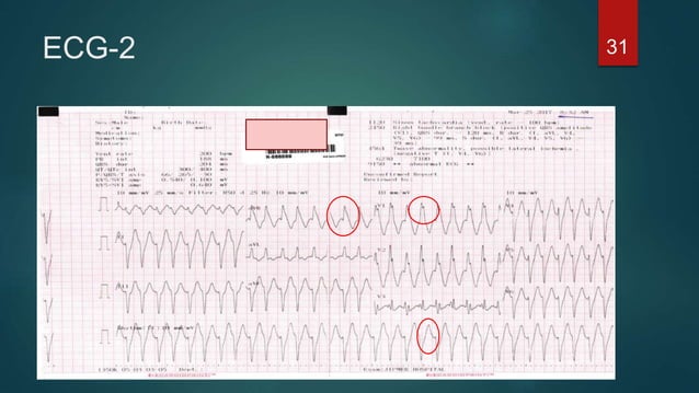 approach to wide complex tachycardia | PPTX | Heart and Cardiovascular ...
