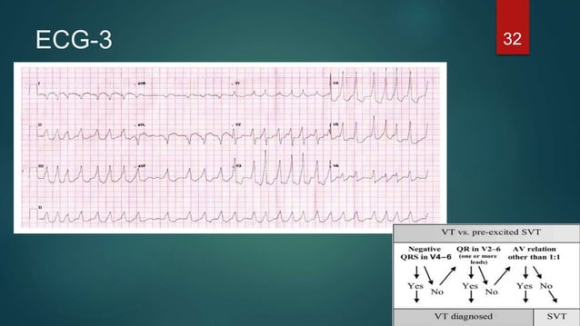 approach to wide complex tachycardia | PPTX | Heart and Cardiovascular ...