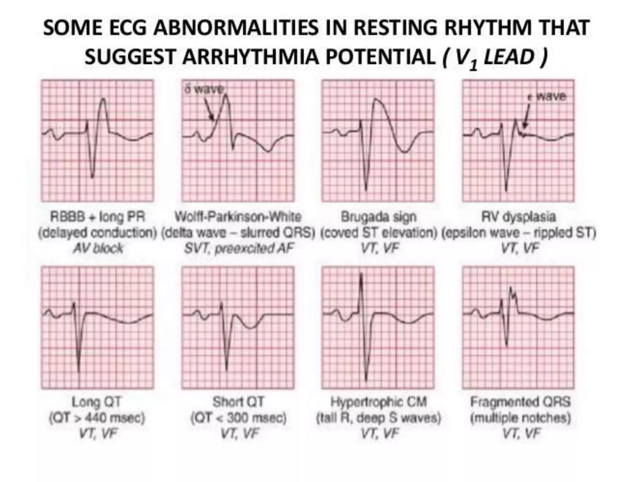 Wide Complex Tachycardia | PPTX