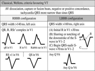 Wide Complex Tachycardia | PPTX