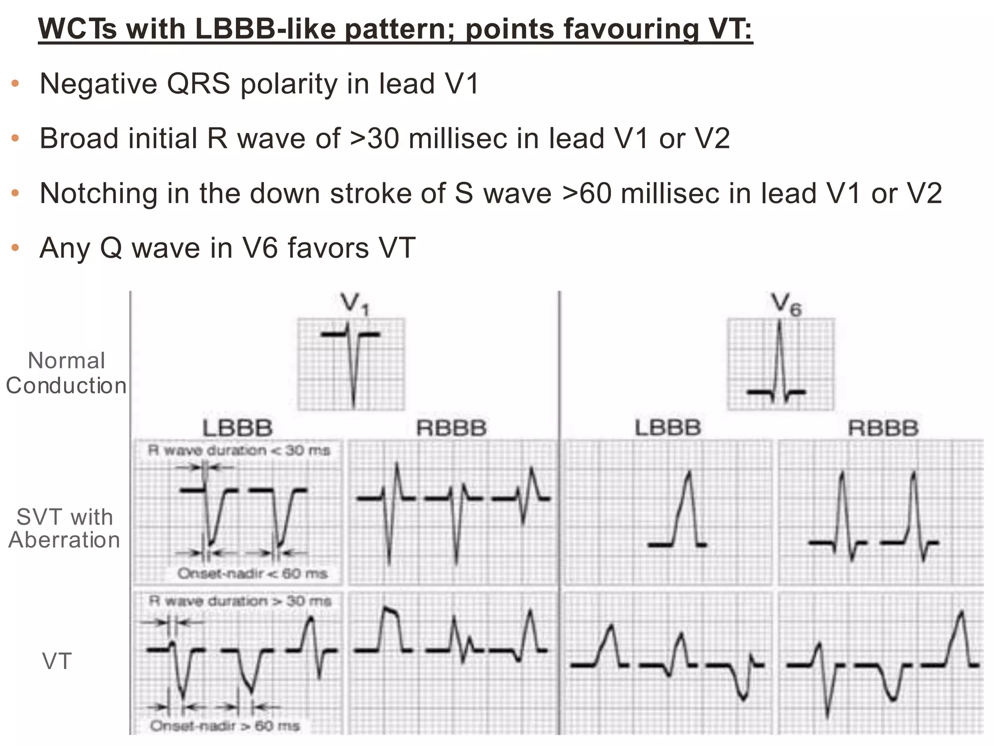 Wide QRS Complex Tachycardia (VT vs SVT) | PPTX