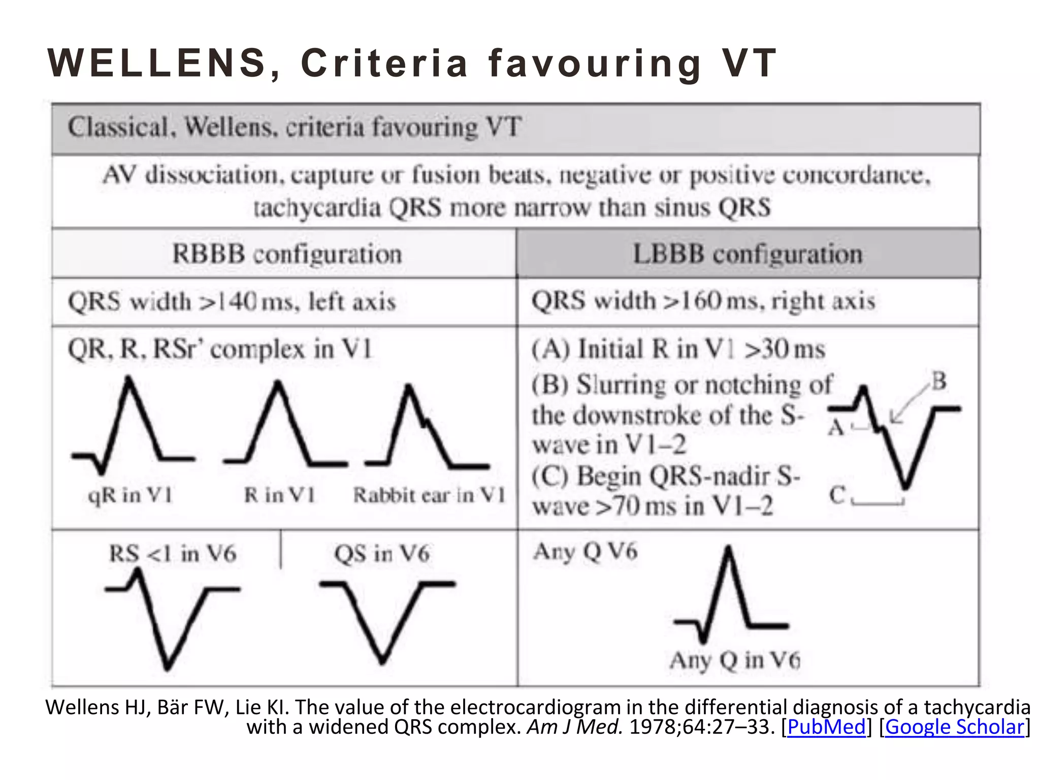 Wide QRS Complex Tachycardia (VT vs SVT) | PPTX