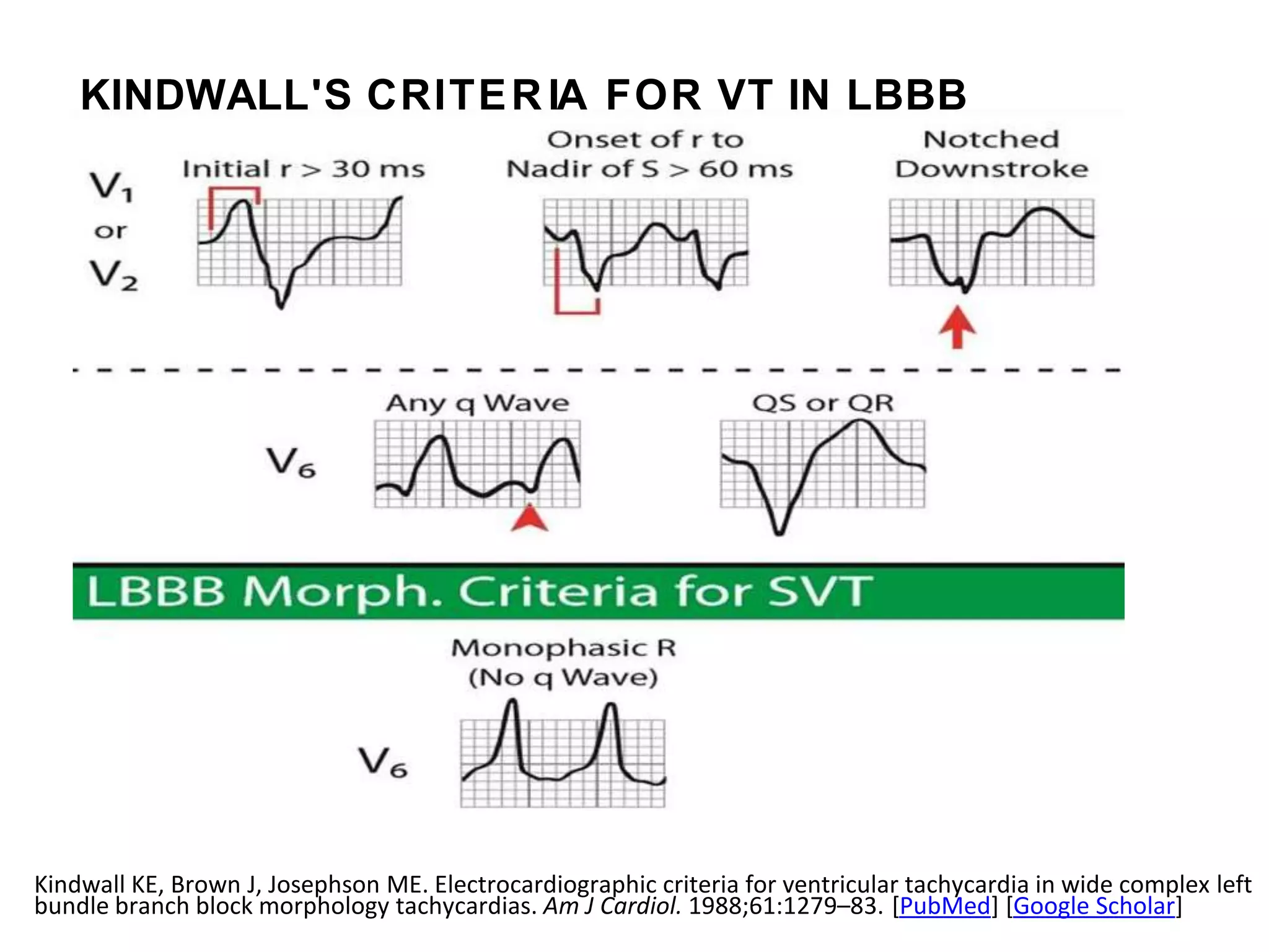Wide QRS Complex Tachycardia (VT vs SVT) | PPTX | Heart and ...