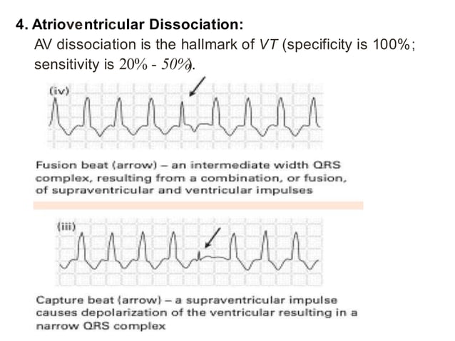 Wide QRS Complex Tachycardia (VT vs SVT) | PPTX | Heart and ...