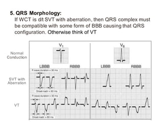 Wide QRS Complex Tachycardia (VT vs SVT) | PPTX