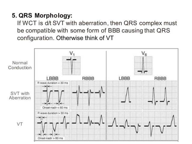 Wide QRS Complex Tachycardia (VT vs SVT) | PPTX | Heart and ...