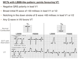 Wide QRS Complex Tachycardia (VT vs SVT) | PPTX