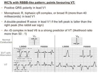 Wide QRS Complex Tachycardia (VT vs SVT) | PPTX