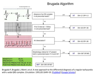 Wide QRS Complex Tachycardia (VT vs SVT) | PPTX