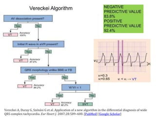 Wide QRS Complex Tachycardia (VT vs SVT) | PPTX