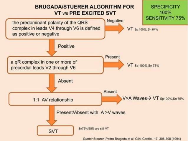 Wide QRS Complex Tachycardia (VT vs SVT) | PPTX | Heart and ...