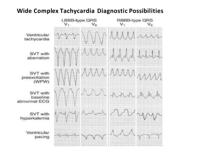 Wide QRS Complex Tachycardia (VT vs SVT) | PPTX | Heart and ...
