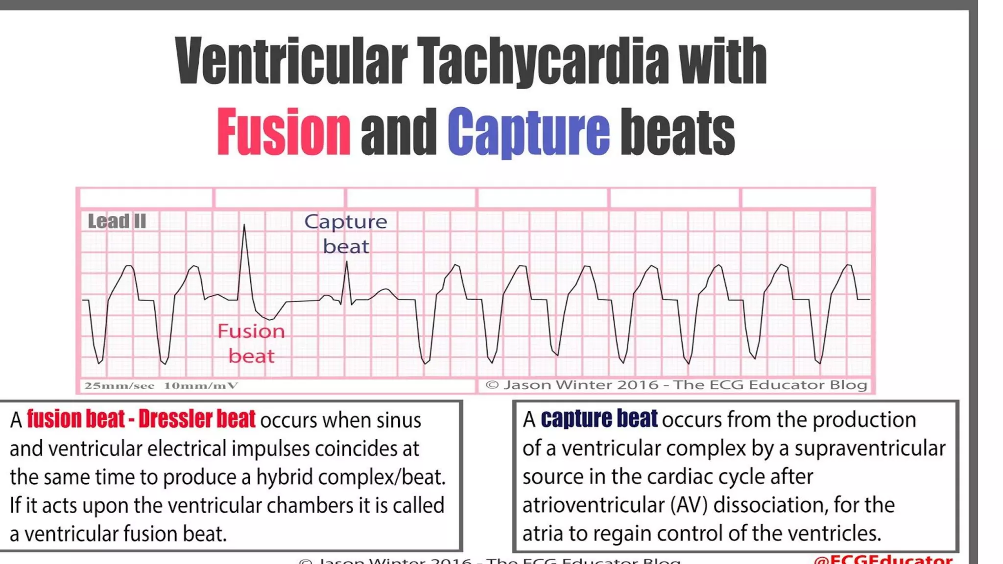 Wide complex tachycardia | PDF