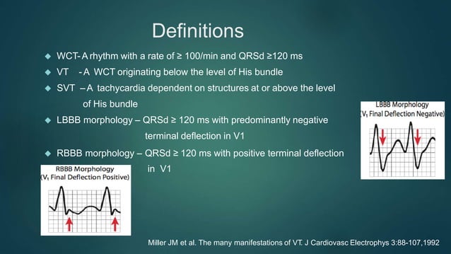 Wide complex tachycardia | PDF