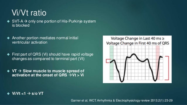 Wide complex tachycardia